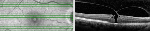 Macular Hole Treatment in Michigan | Retina Specialists